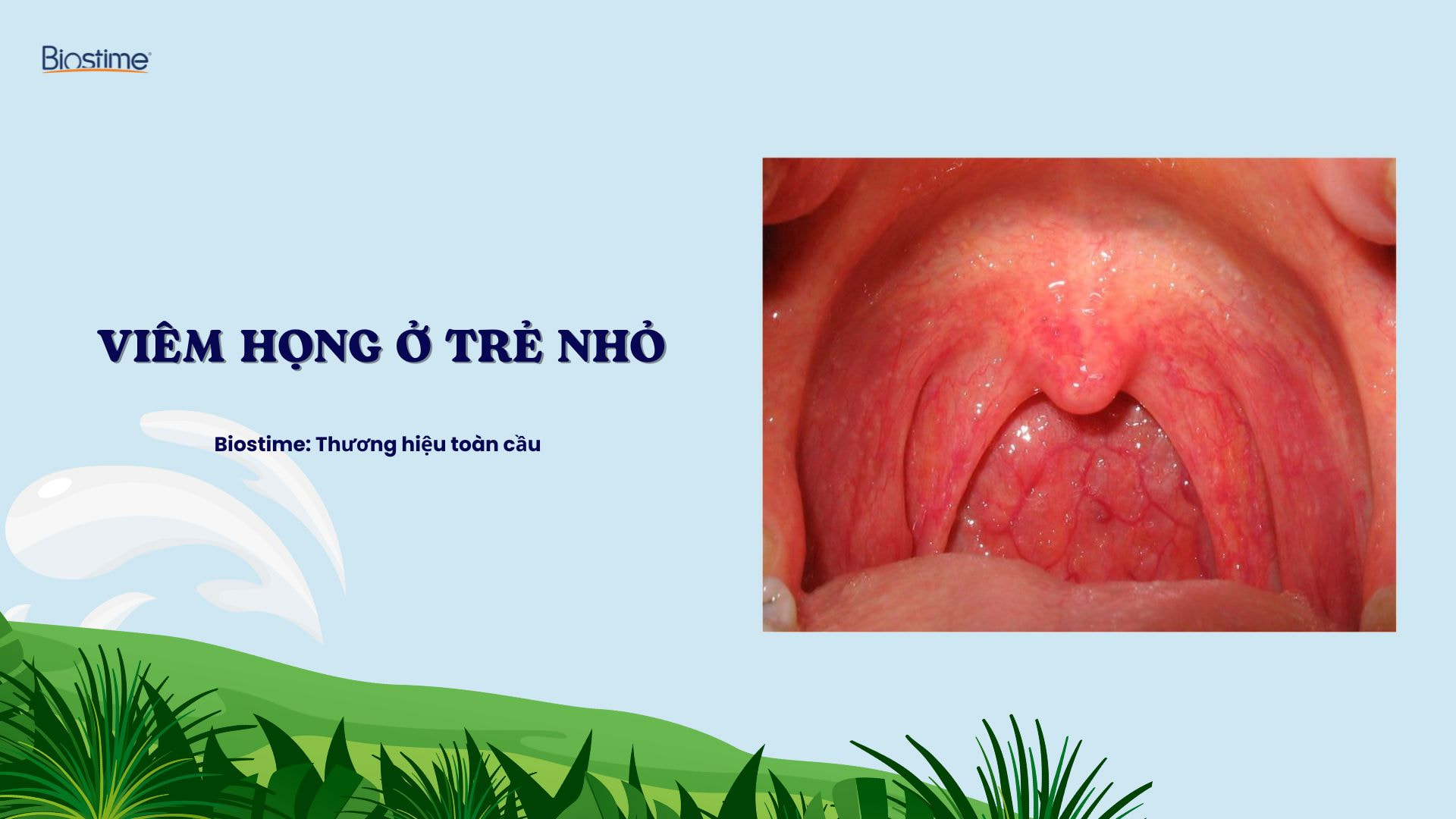 Viêm họng ở trẻ nhỏ: nguyên nhân và cách xử lý tại nhà